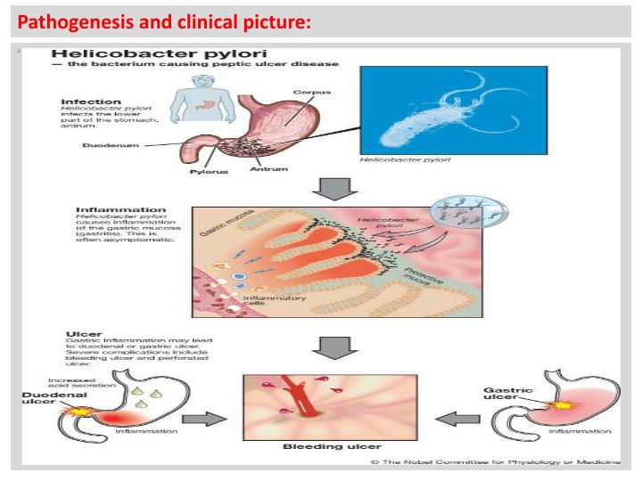 PPT - Peptic Ulcer and Helicobacter pylori infection: PowerPoint ...