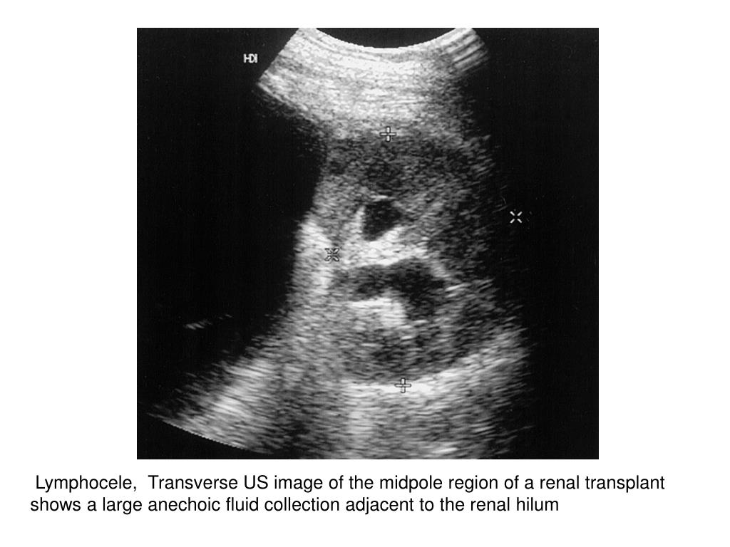 PPT - “ Lymphocele ” After Kidney Transplantation PowerPoint ...
