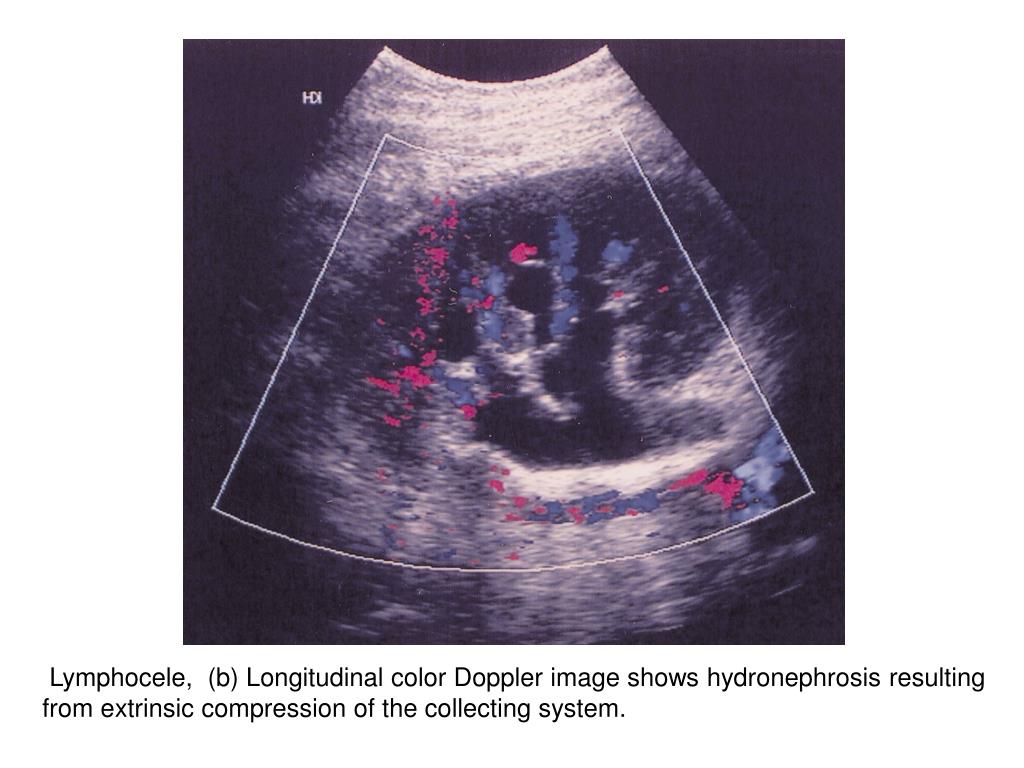 PPT - “ Lymphocele ” After Kidney Transplantation PowerPoint ...