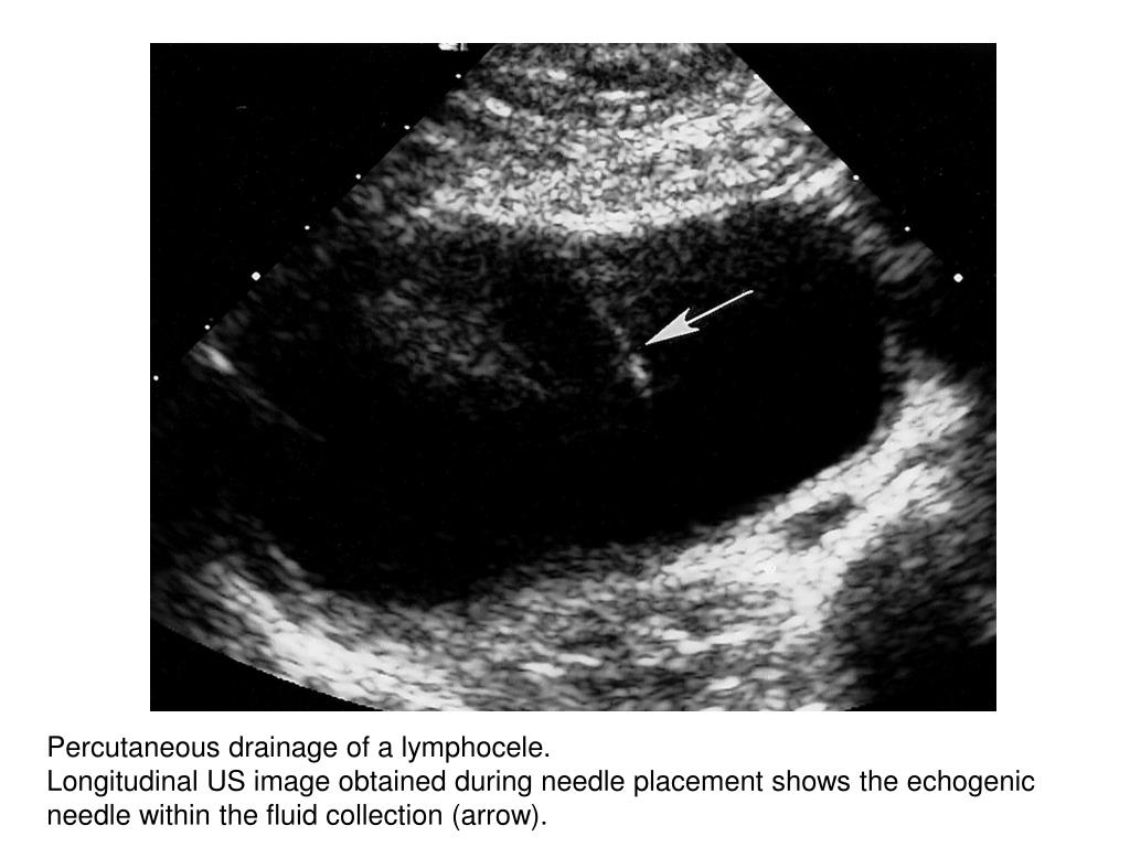 PPT - “ Lymphocele ” After Kidney Transplantation PowerPoint ...