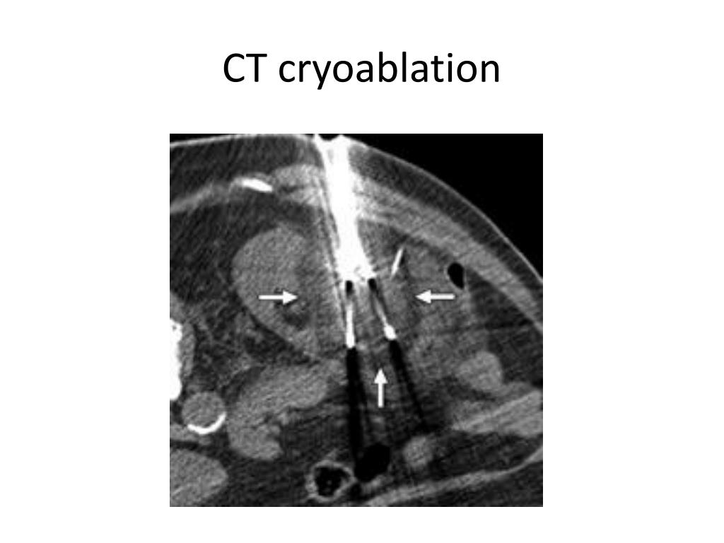 PPT - Minimally Invasive Cancer Therapies in Interventional Radiology ...