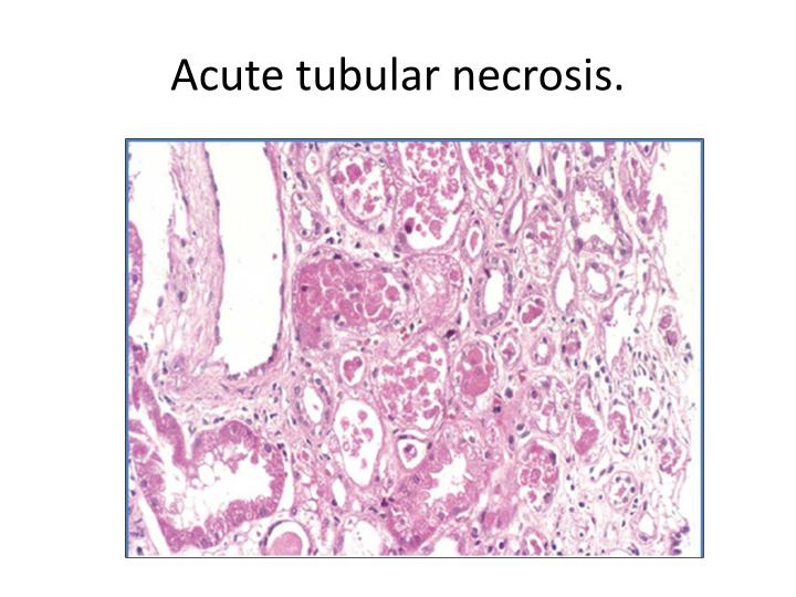 PPT - Kidney- Tubulo -interstitial disorders PowerPoint Presentation ...