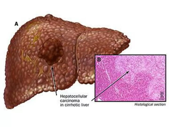 PPT - Hepatocellular carcinoma PowerPoint Presentation, free download ...