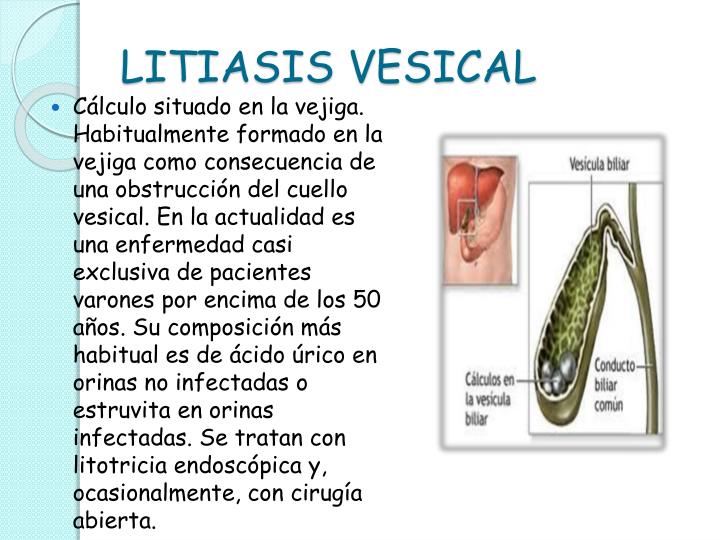 PPT - LITIASIS RENAL PowerPoint Presentation - ID:2240886