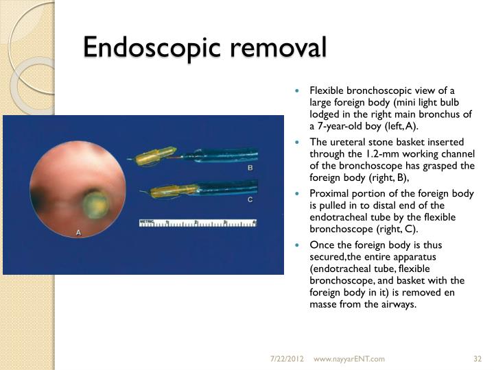PPT - Laryngo Tracheo Bronchial Foreign Bodies PowerPoint Presentation ...