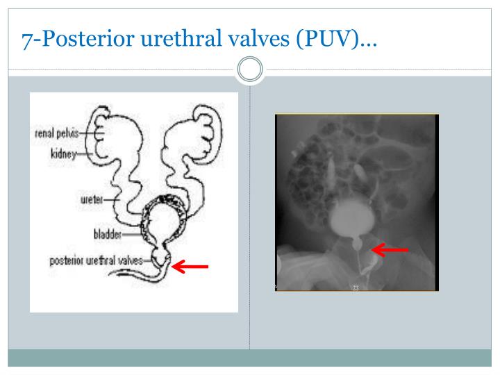 Posterior Urethral Valves