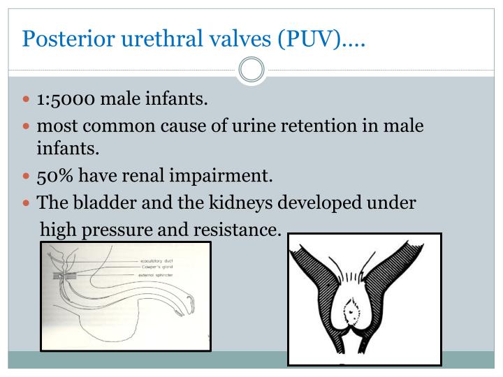 Posterior Urethral Valves