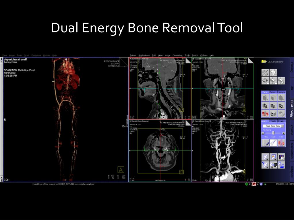 PPT - Dual energy Ct in the acute care setting PowerPoint Presentation ...