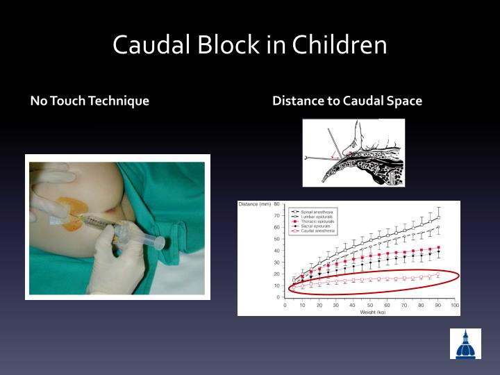 PPT - Kiddie-Caudals Caudal Epidural Analgesia in Everyday Pediatric ...