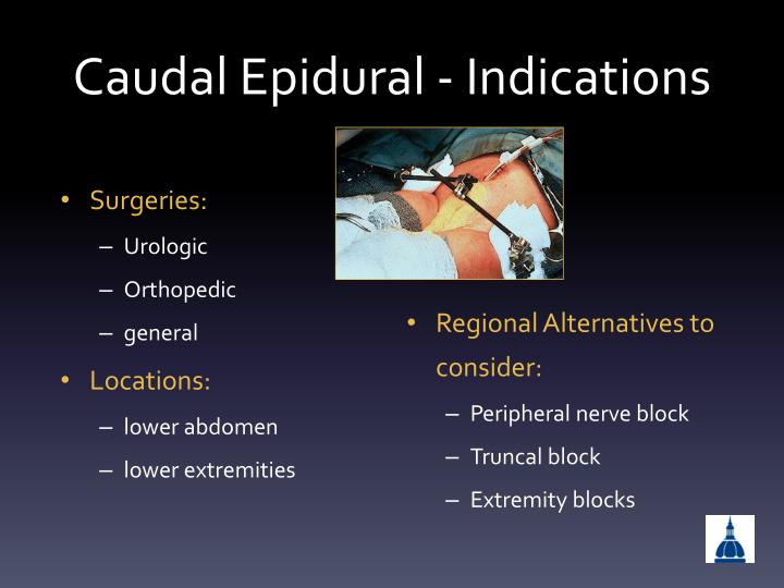 PPT - Kiddie-Caudals Caudal Epidural Analgesia in Everyday Pediatric ...