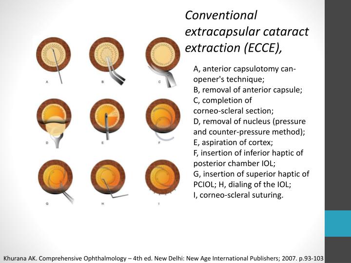PPT - KATARAK PowerPoint Presentation - ID:2243048