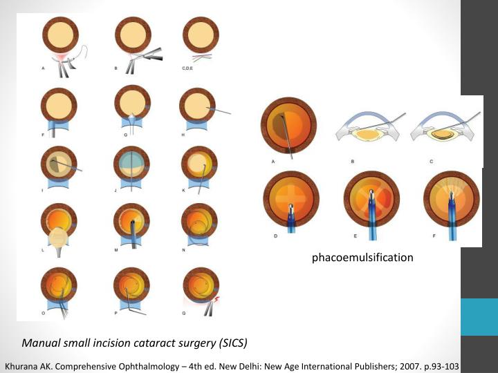 PPT - KATARAK PowerPoint Presentation - ID:2243048