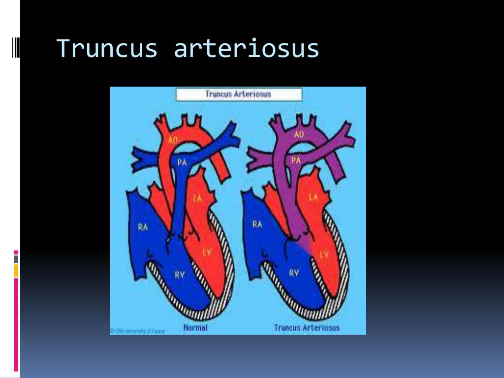 PPT - Anaesthetic concerns in cyanotic congenital heart disease ...
