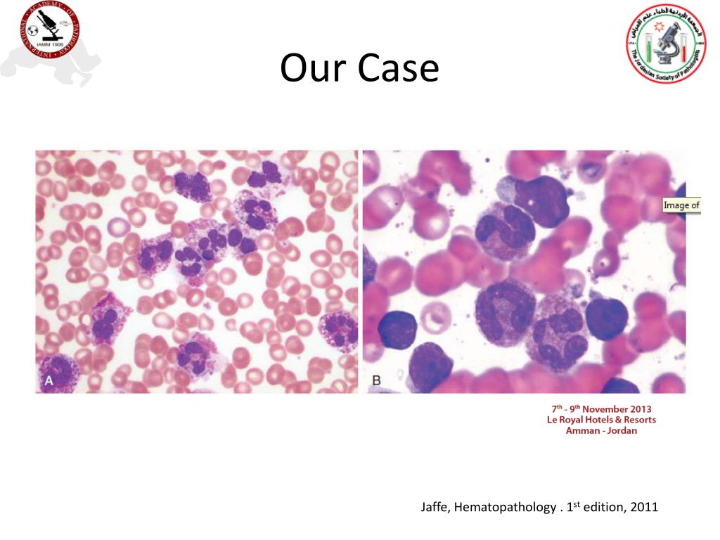 PPT - A challenging case of eosinophilia, the era of personalized ...