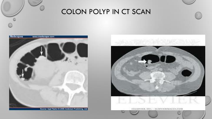 PPT - Colon cancer PowerPoint Presentation - ID:2245225