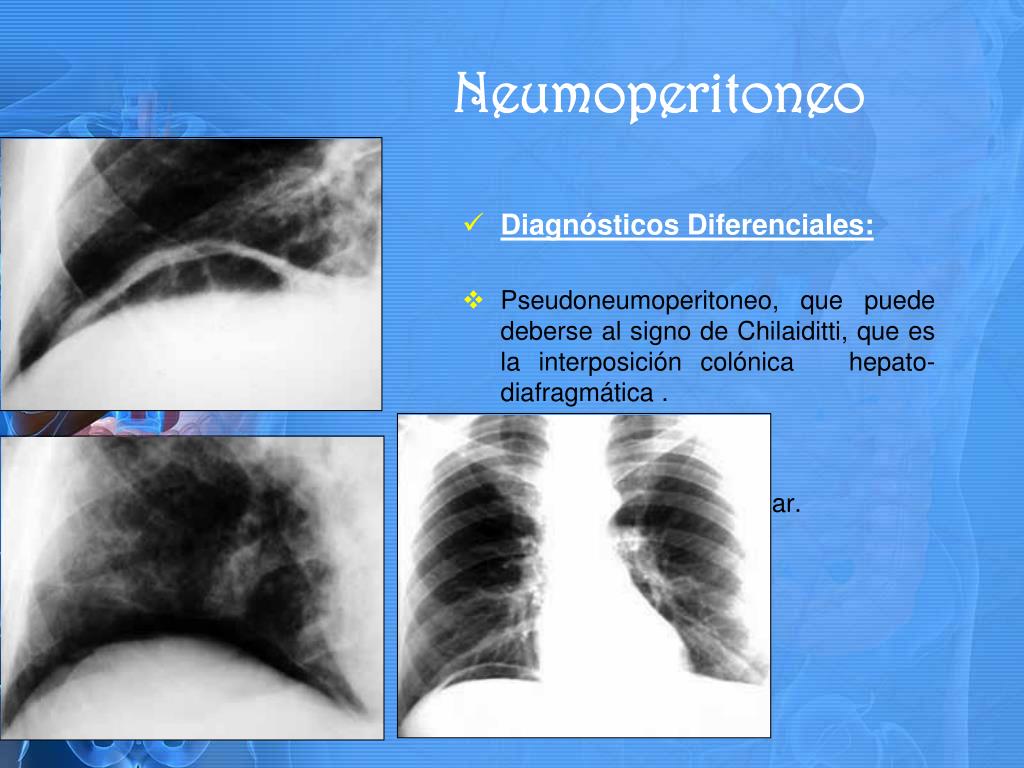 PPT - Imágenes en abdomen. Aire donde no tiene que haber aire ...