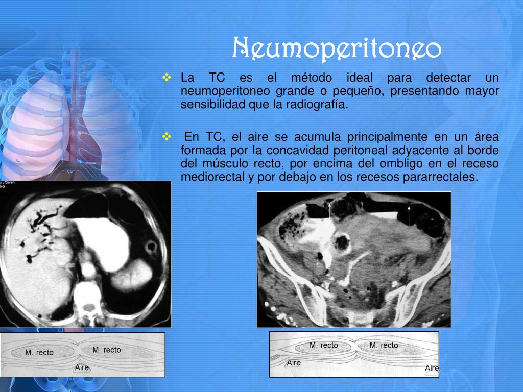 PPT - Imágenes en abdomen. Aire donde no tiene que haber aire ...