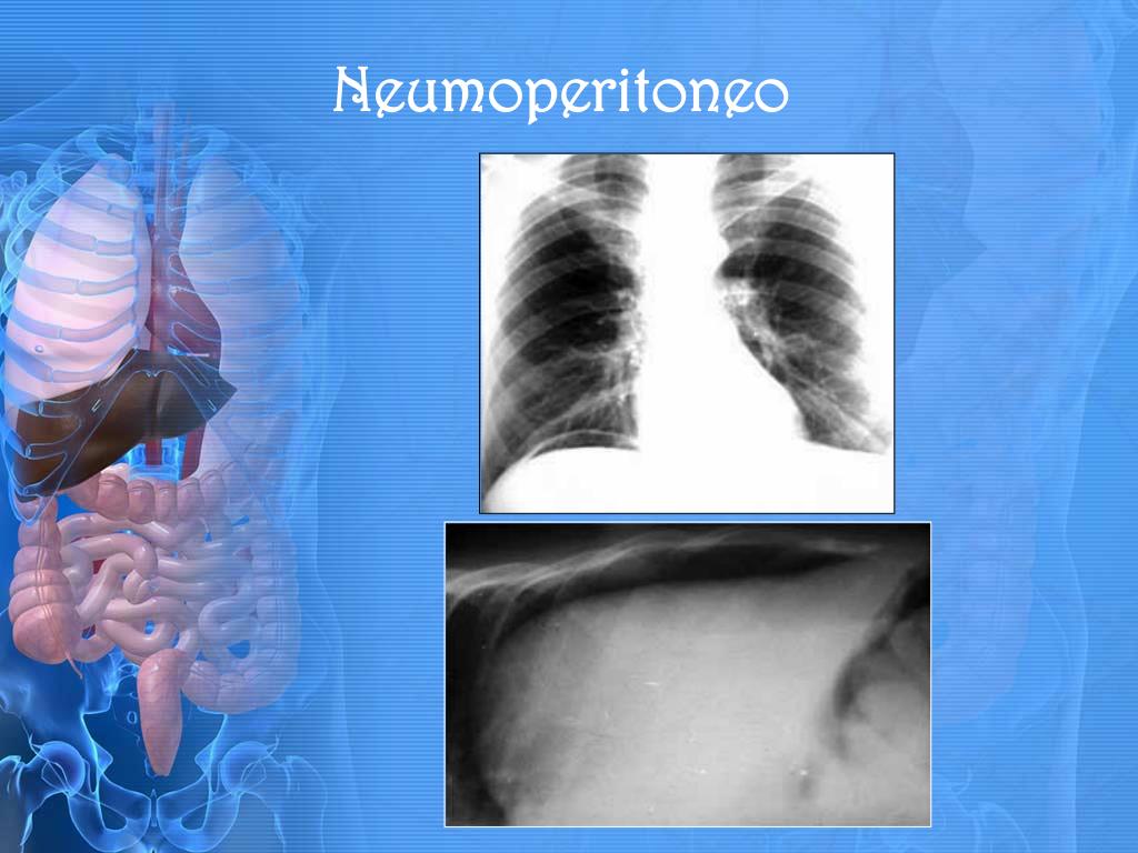 PPT - Imágenes en abdomen. Aire donde no tiene que haber aire ...