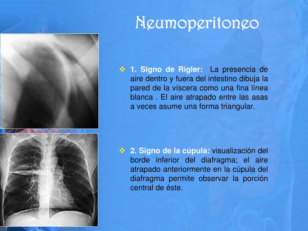 Signos Radiologicos Del Neumoperitoneo