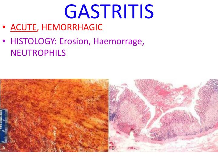 PPT - Lecture 8.3 rad240 pathology PowerPoint Presentation - ID:2250916