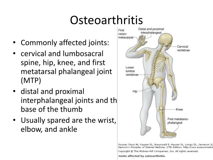 PPT - Rheumatology: OSTEOARTHRITIS RHEUMATOID ARTHRITIS PowerPoint ...