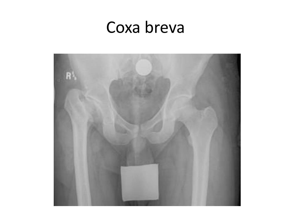 PPT - Surgical Treatment for Perthes Disease PowerPoint Presentation ...