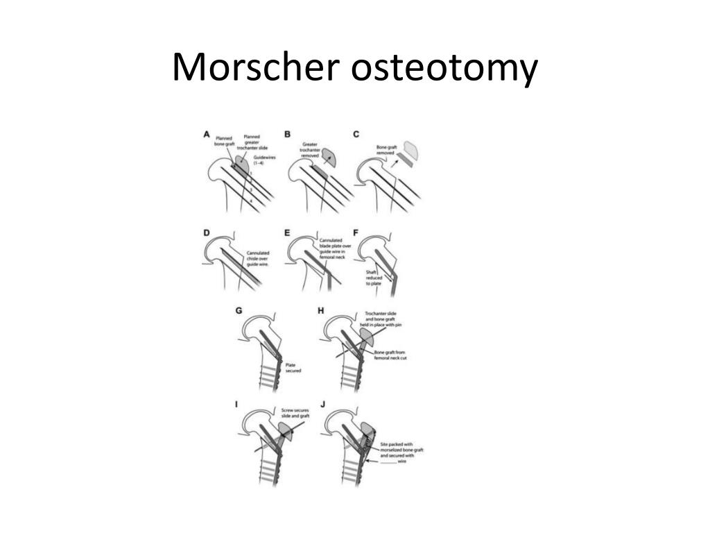 PPT - Surgical Treatment for Perthes Disease PowerPoint Presentation ...
