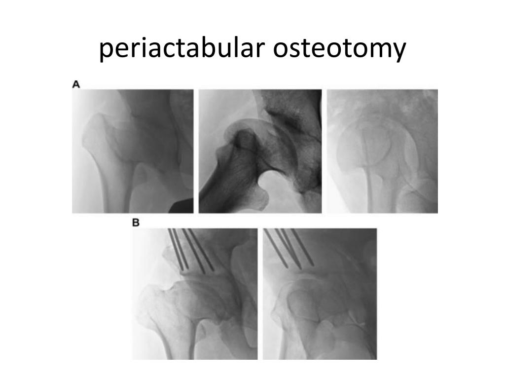 PPT - Surgical Treatment for Perthes Disease PowerPoint Presentation ...