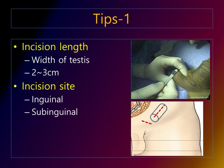 PPT - Tips & Tricks: Scrotal disease - Varicocele - PowerPoint ...