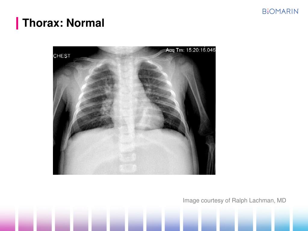 PPT - Morquio A: Musculoskeletal manifestations PowerPoint Presentation ...