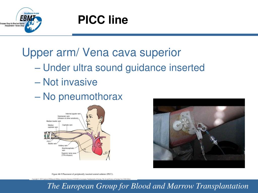 PPT - How well are we doing with CVC’s in EBMT? London 5th October 2012 ...