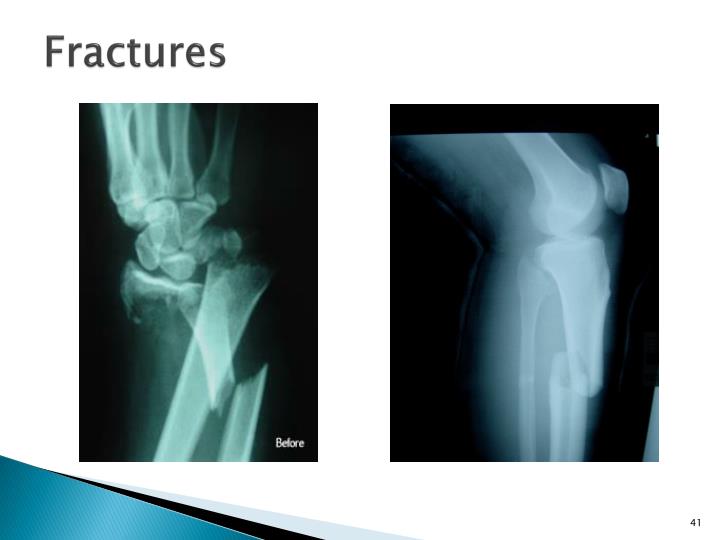 PPT - Chapter 7:4 Skeletal System PowerPoint Presentation - ID:2255263