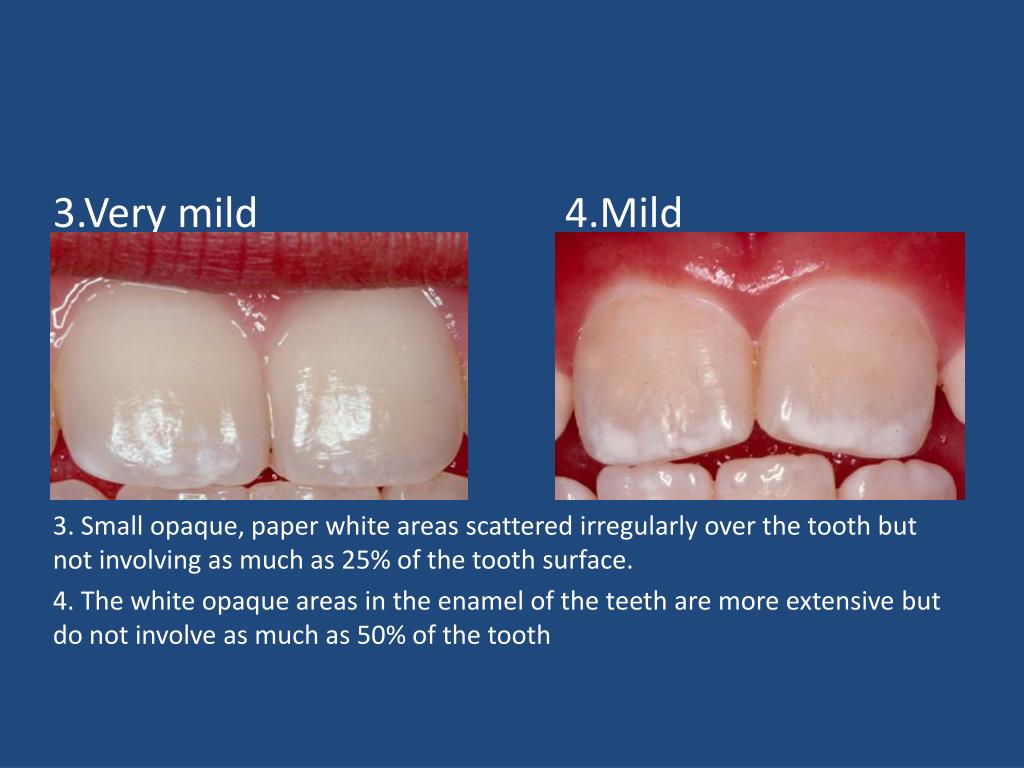 PPT - DENTAL FLUOROSIS PowerPoint Presentation, free download - ID:2256165
