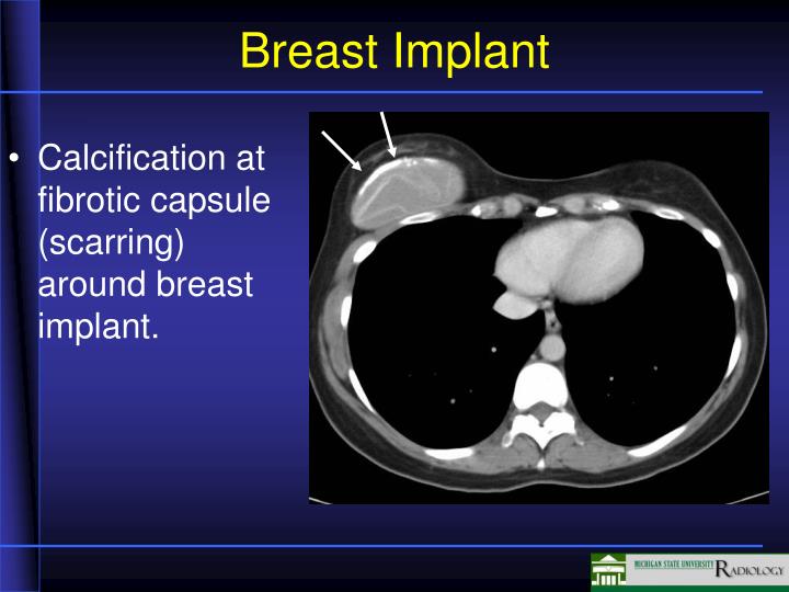 Ppt Soft Tissue Calcifications Powerpoint Presentation Id 2257854