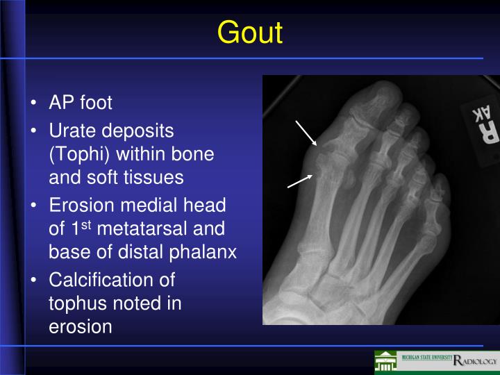 PPT - Soft Tissue Calcifications PowerPoint Presentation - ID:2257854