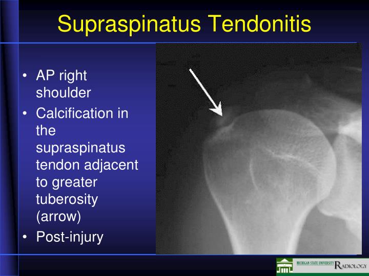 PPT - Soft Tissue Calcifications PowerPoint Presentation - ID:2257854