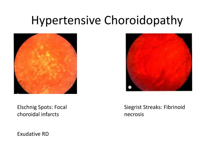 PPT - Update on Hypertensive Retinopathy PowerPoint Presentation - ID ...