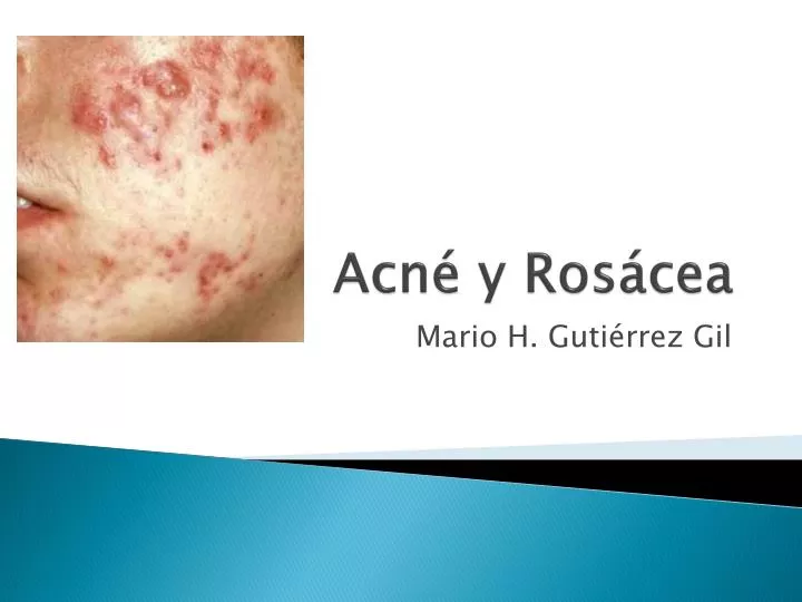 PPT - Acné y Rosácea PowerPoint Presentation, free download - ID:2262106