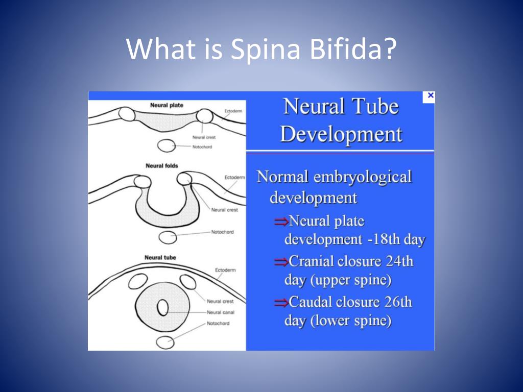 PPT - Myelomeningocele: Prenatal and Postnatal Treatment and ...