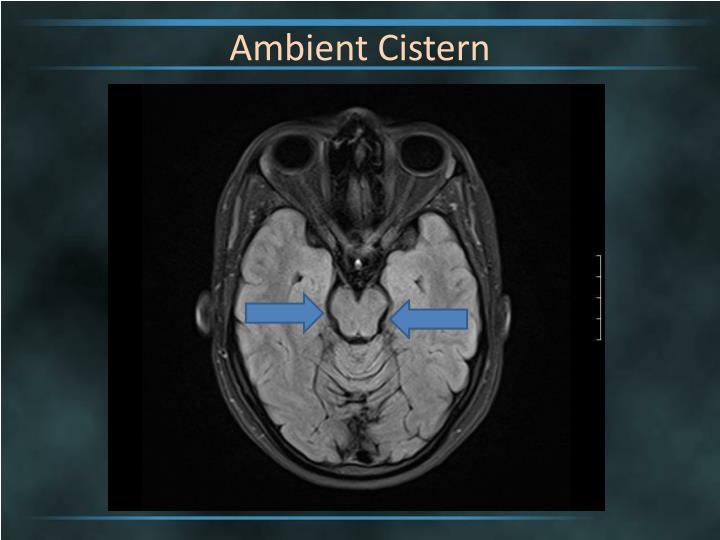 PPT - Brain Cisterns PowerPoint Presentation - ID:2263744