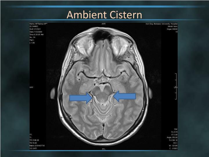 PPT - Brain Cisterns PowerPoint Presentation - ID:2263744