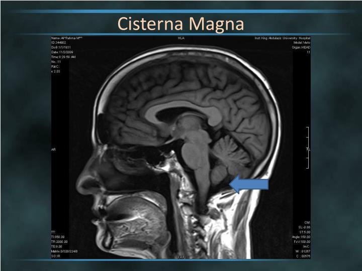 PPT - Brain Cisterns PowerPoint Presentation - ID:2263744