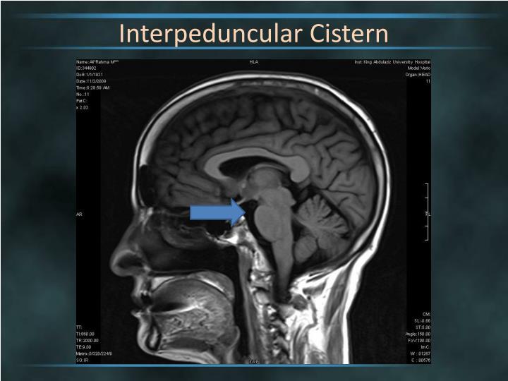 PPT - Brain Cisterns PowerPoint Presentation - ID:2263744