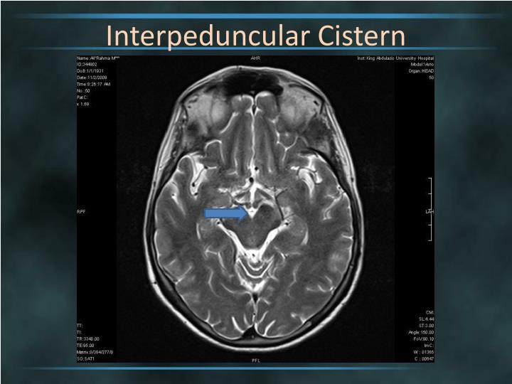 PPT - Brain Cisterns PowerPoint Presentation - ID:2263744
