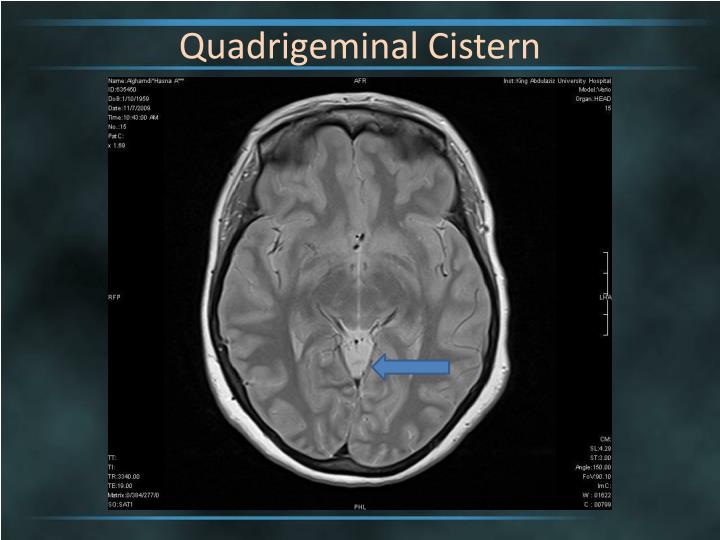 PPT - Brain Cisterns PowerPoint Presentation - ID:2263744
