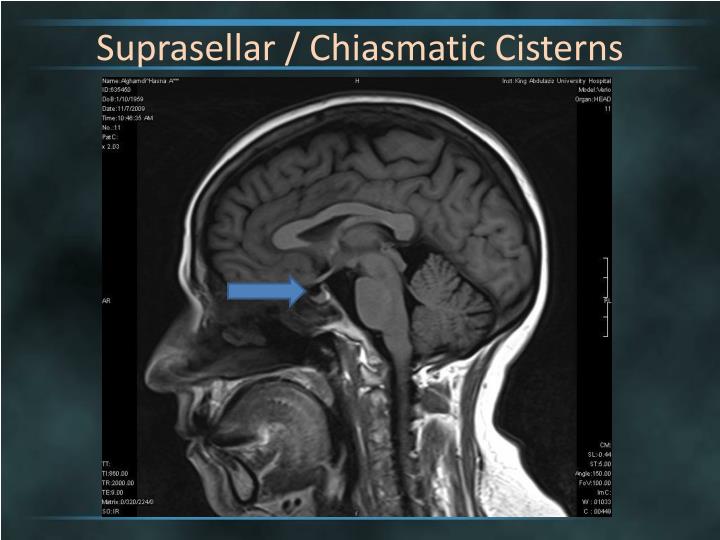 PPT - Brain Cisterns PowerPoint Presentation - ID:2263744