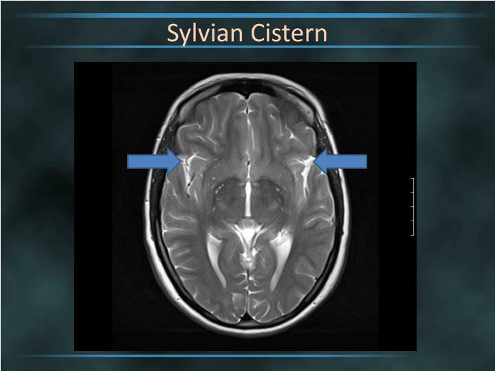 PPT - Brain Cisterns PowerPoint Presentation - ID:2263744