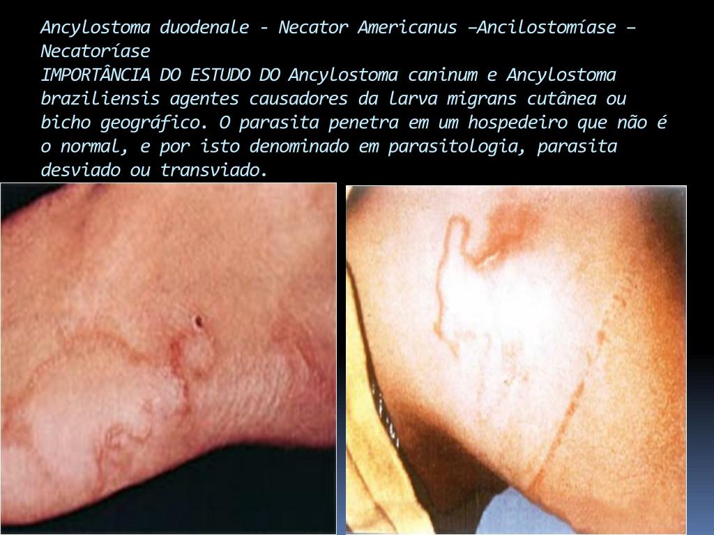 PPT - Ancylostoma duodenale – Ancilostomíase Necator americanus - Necatoríase PowerPoint ...