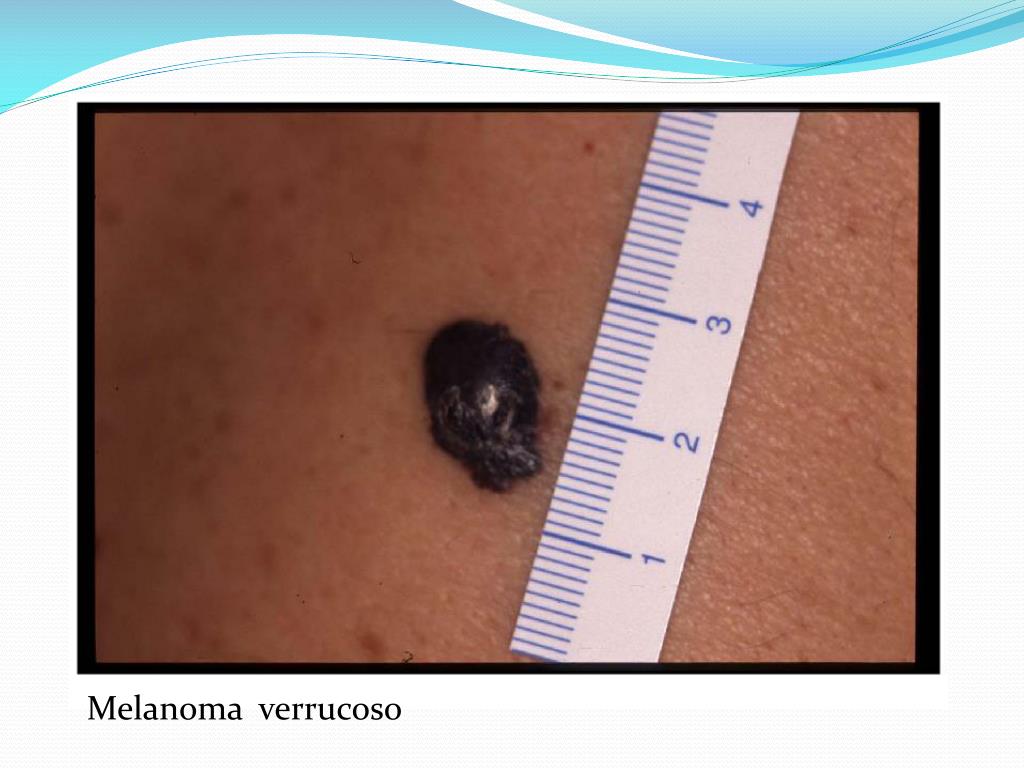 PPT - CONOSCI LA TUA PELLE PREVIENI IL MELANOMA PowerPoint Presentation ...