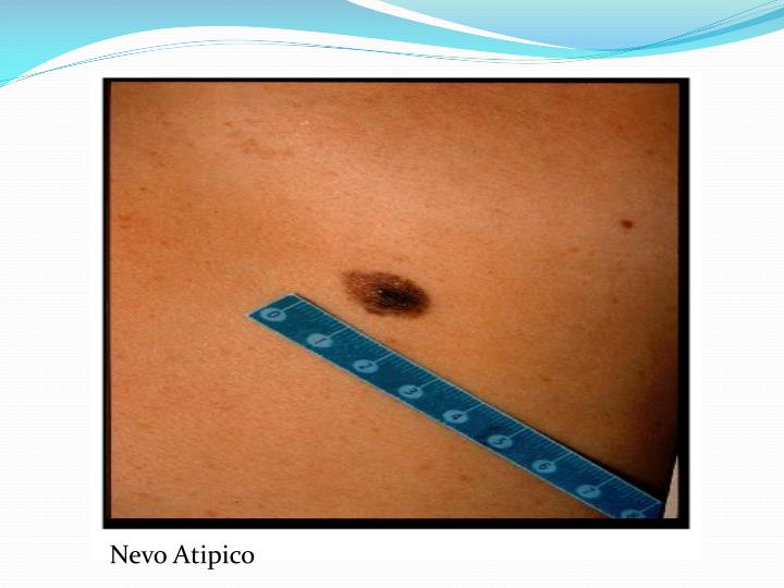 PPT - CONOSCI LA TUA PELLE PREVIENI IL MELANOMA PowerPoint Presentation ...